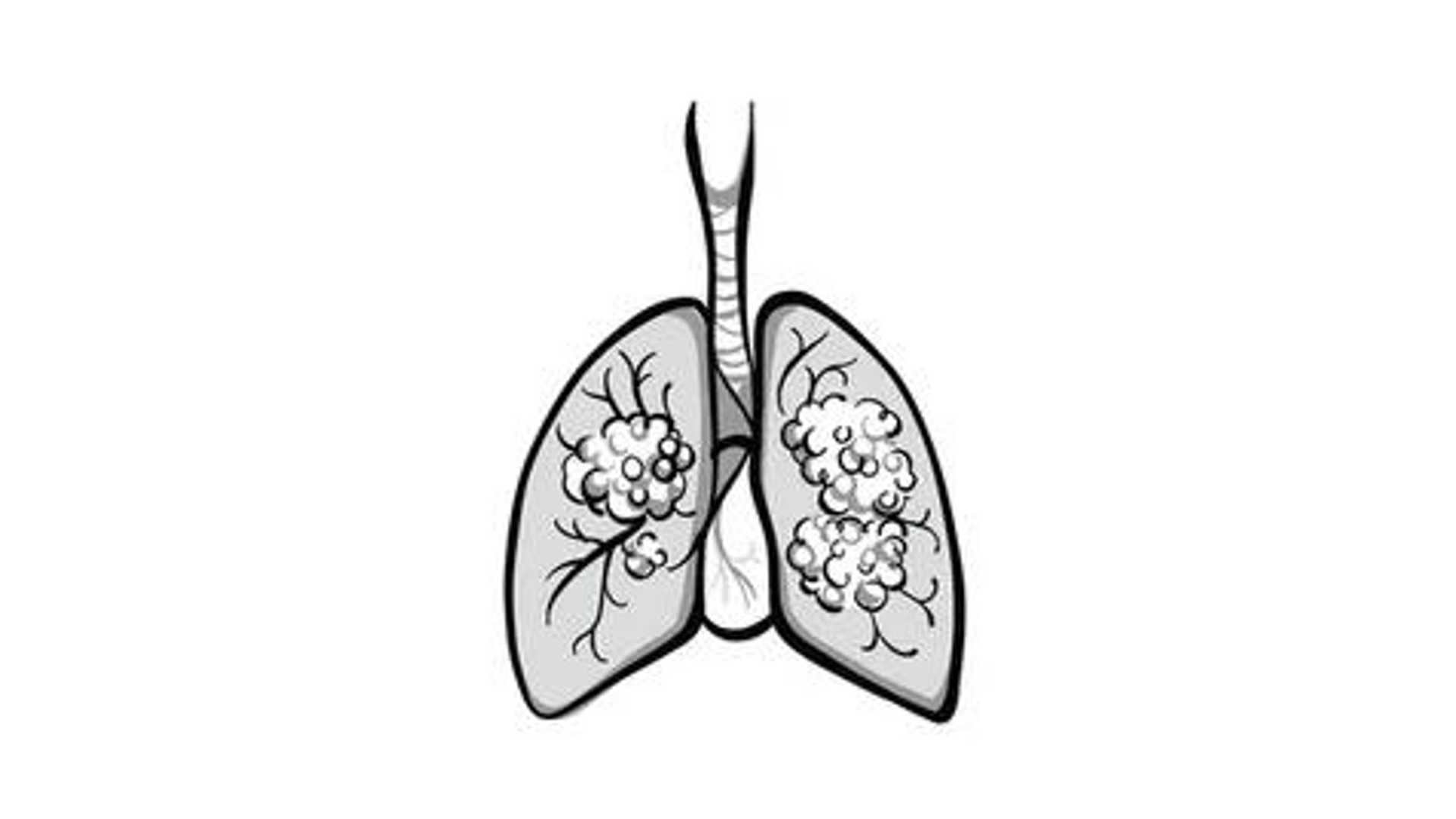 Innovative Treatment for HER2-Mutant NSCLC in Phase 3 Trial - Fusion Chat